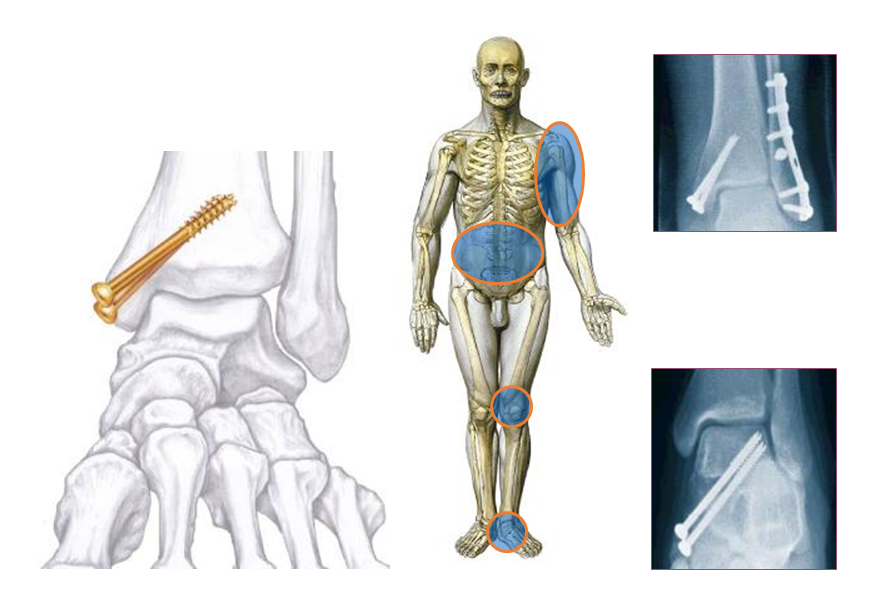 Cannulated Screw System – Orthoprimed